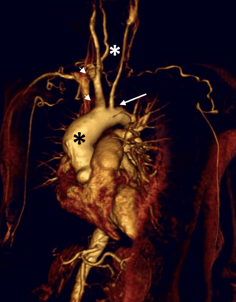 Cardiovascular Magnetic Resonance (CMR) | UK CARDIO-IMID Partnership
